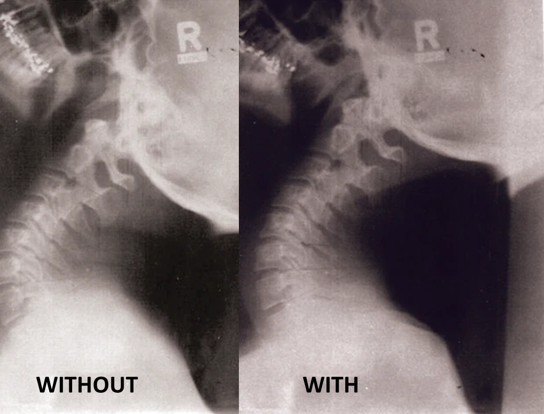 IMPACTO® Ergonomic Neck Support System is Doctor Designed and Approved